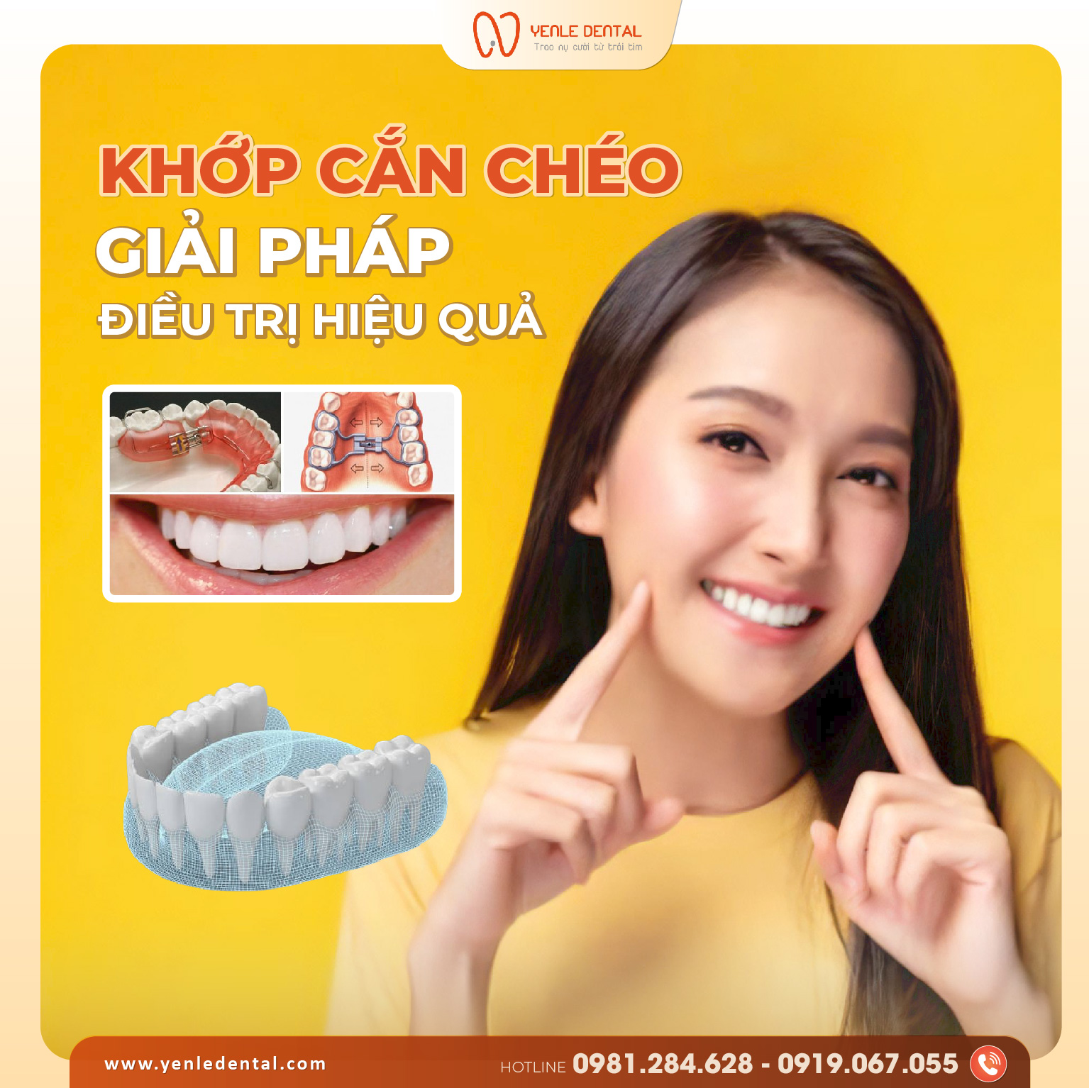 KHỚP CẮN CHÉO: TRIỆU CHỨNG & GIẢI PHÁP ĐIỀU TRỊ HIỆU QUẢ